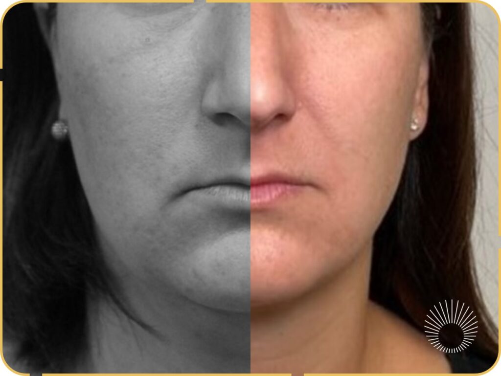 Neck Shaping: Submental Liposuction - Dr. Sara Dickie Plastic ...