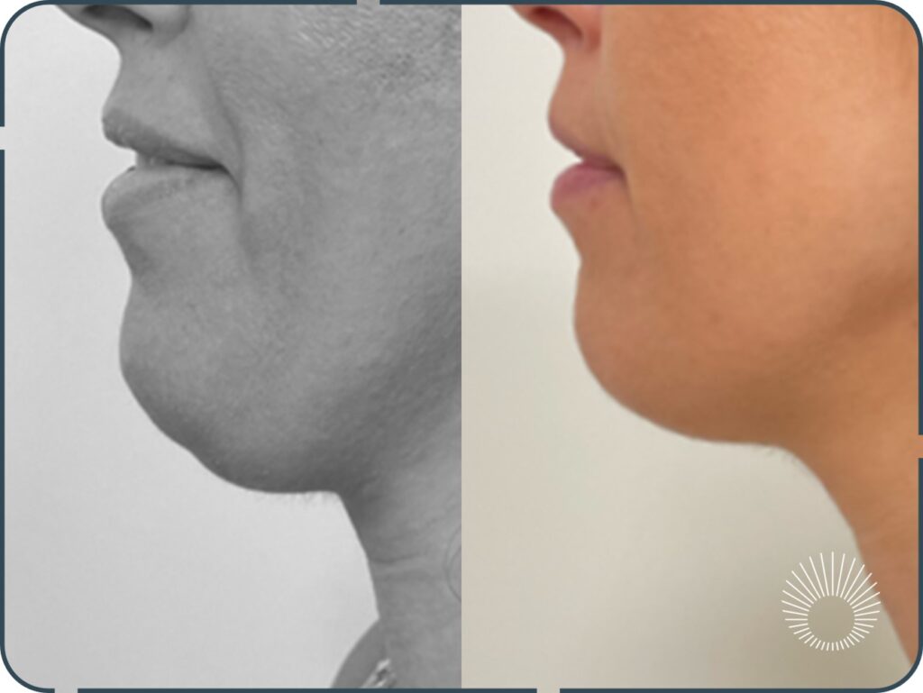 Kybella: Double Chin Correction - Dr. Sara Dickie Plastic ...