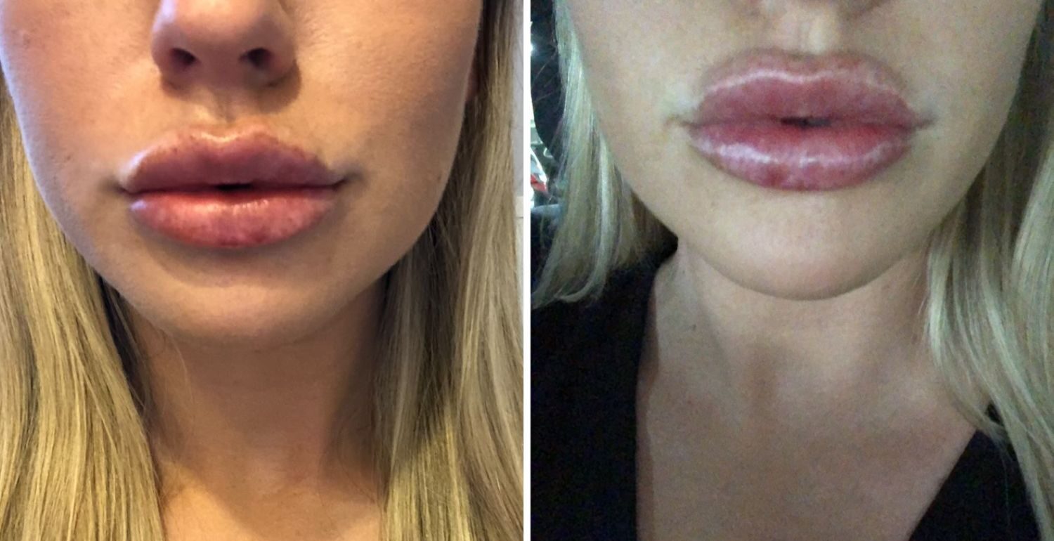 Modern Filler: Addressing Filler Fatigue, Migration, and Safety - Dr ...